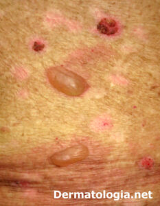 Penfigóide bolhoso - Dermatologia.netDermatologia.net